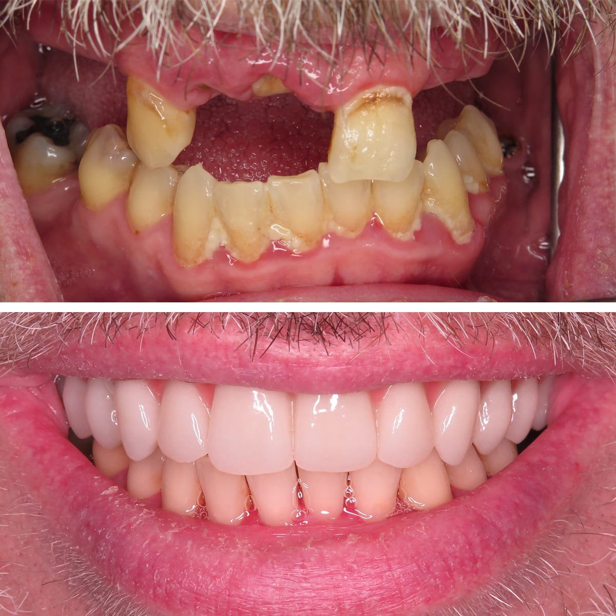 Dental Implants Before & After Results (Over 30 Images)