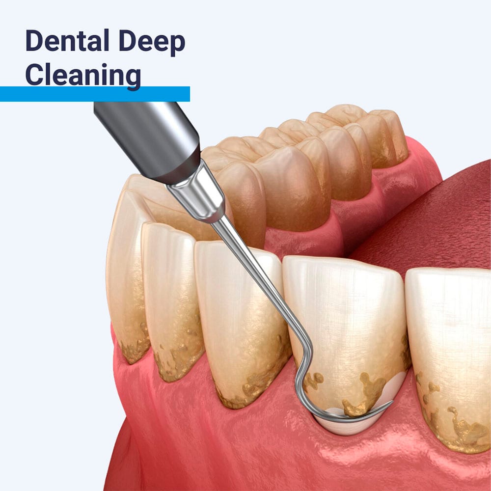 Deep Cleaning in Franklin Square, NY | Teeth Scaling Nassau County Deep Cleaning in Franklin Square, NY | Teeth Scaling Nassau County